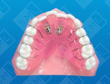 Mini-Screw Appliance U , Individual Tooth Movement Appliance, Dental ...